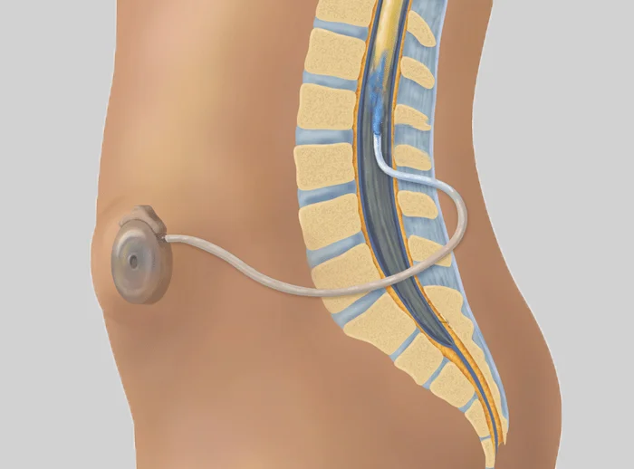 Intrathecal Baclofen Pump